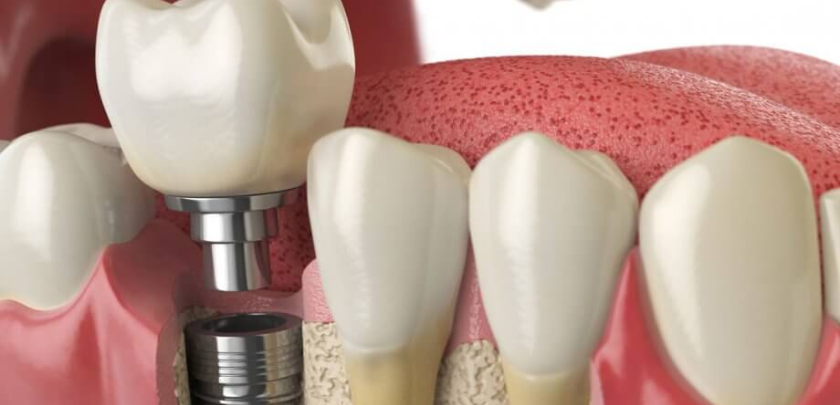 Steps to Getting Dental Implants: A Comprehensive Guide