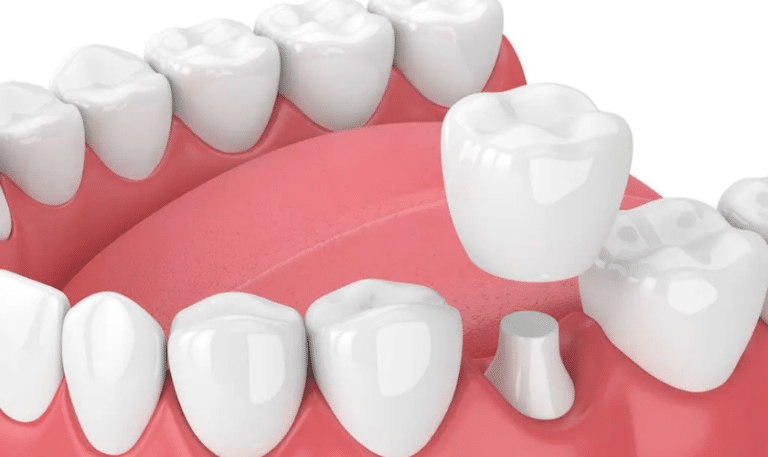 How to Remove Dental Cement from a Crown: Step-by-Step Guide