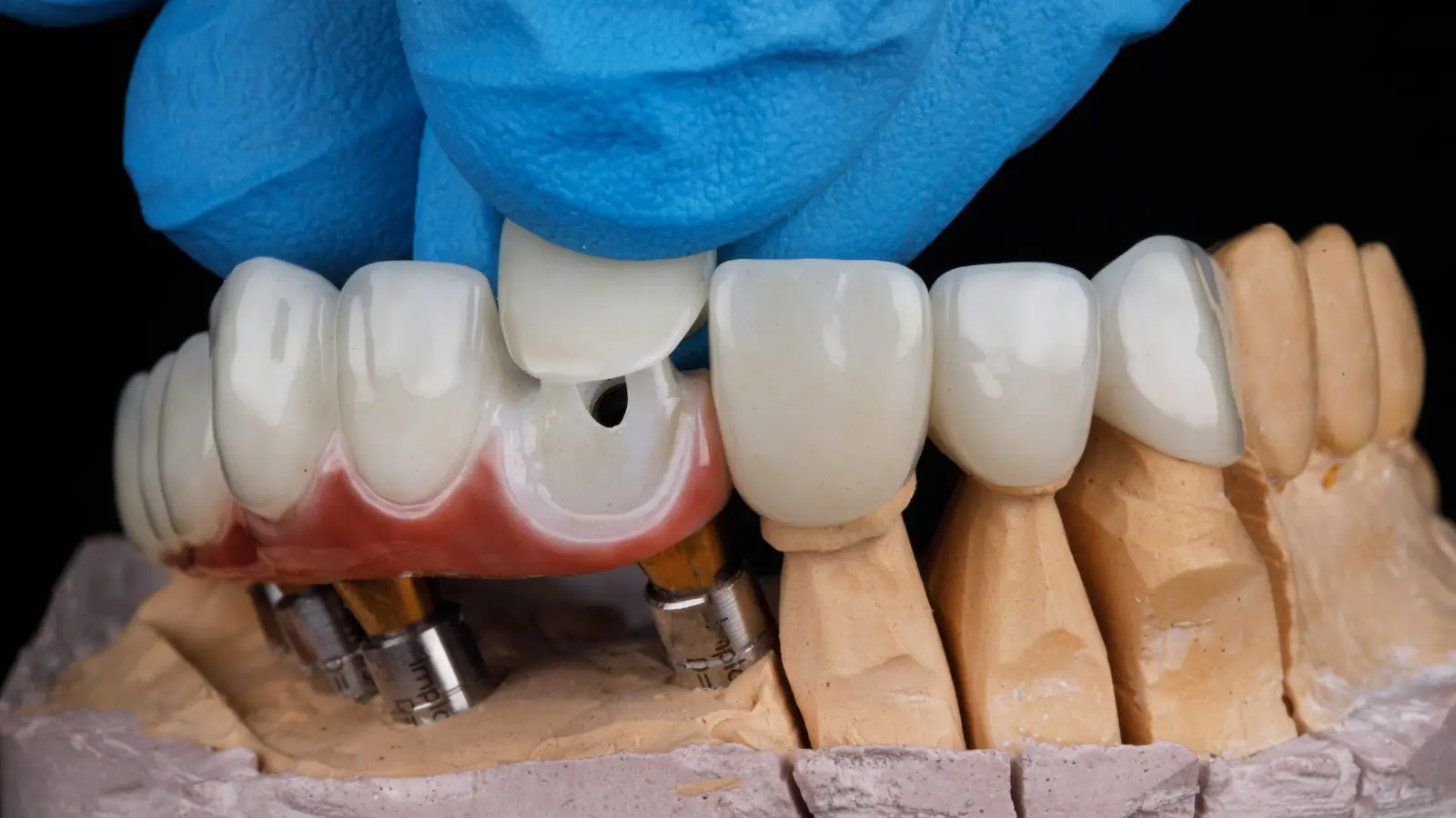 How to Remove Dental Cement from a Crown: Step-by-Step Guide