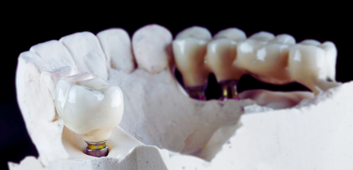 Missing Teeth? Discover How Dental Bridges Can Help