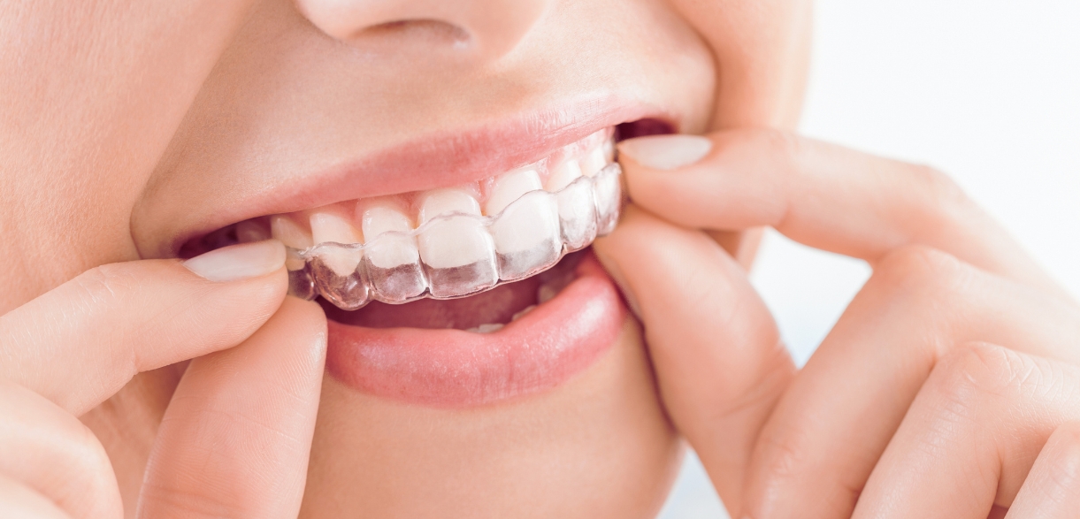Can Invisalign Fix Orthodontic Issues? Find Out How It Works