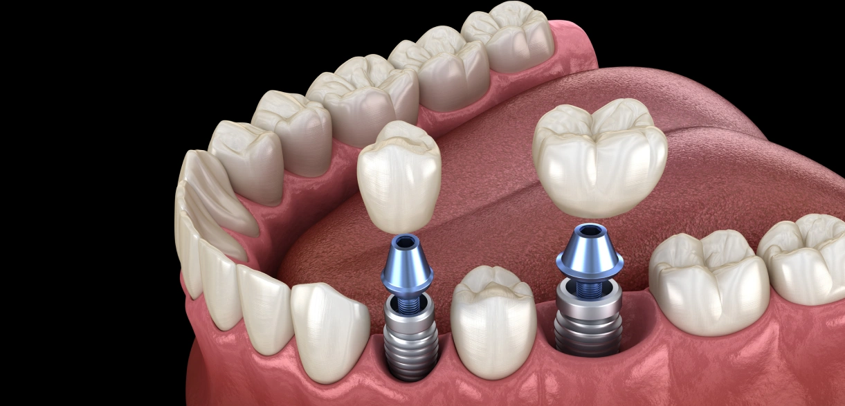 Step-by-Step Dental Implant Procedure in Georgetown